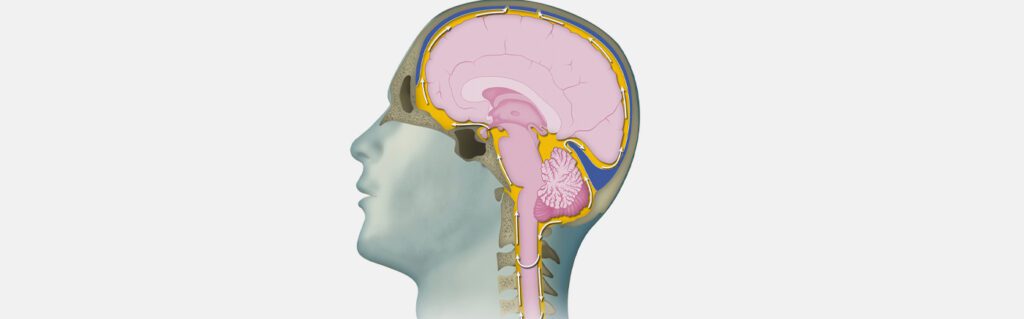 CSF Leak Diagnosis & Treatment in Tampa