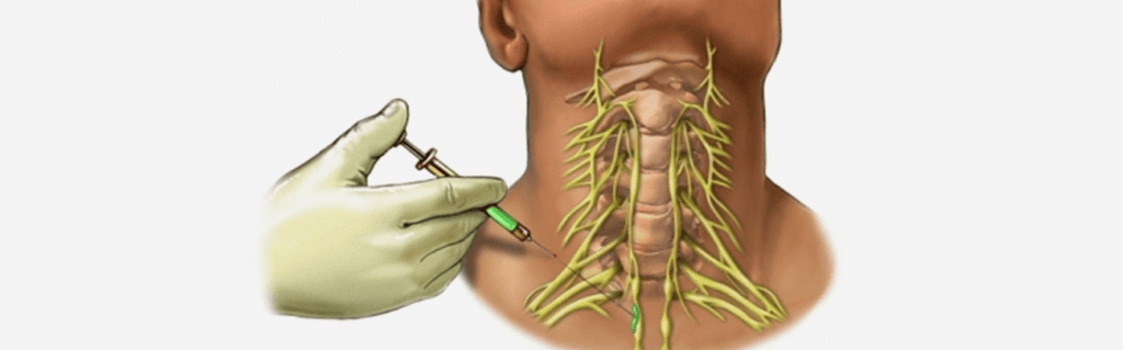 Stellate Ganglion Block — TampaPainMD
