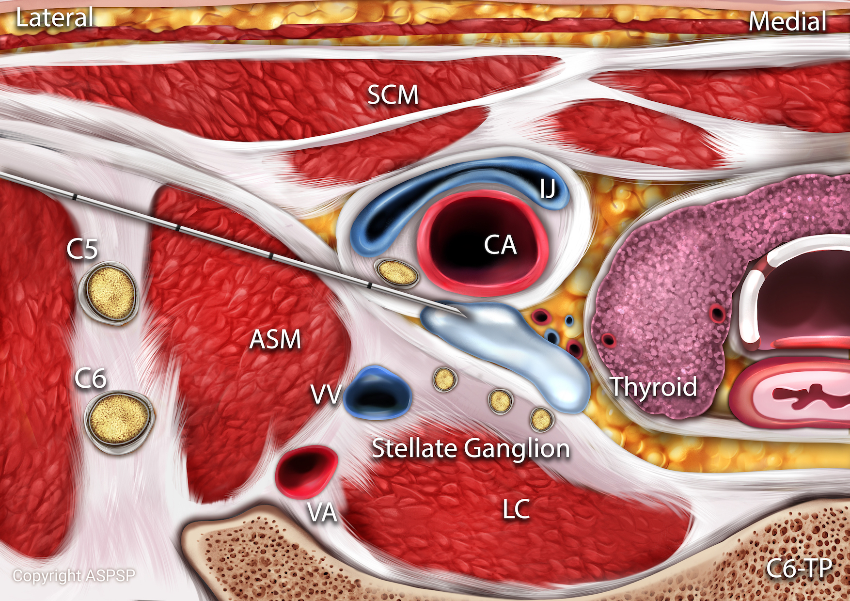 Stellate Ganglion Block — TampaPainMD